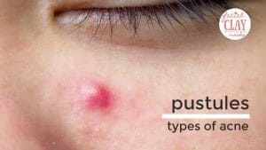 Acne 101: What are the Different Types of Acne?