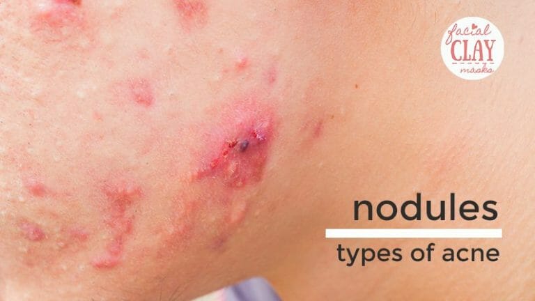 Acne 101: What are the Different Types of Acne?