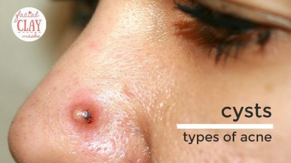 Acne 101: What are the Different Types of Acne?