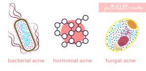 Acne 101: What are the Different Types of Acne?
