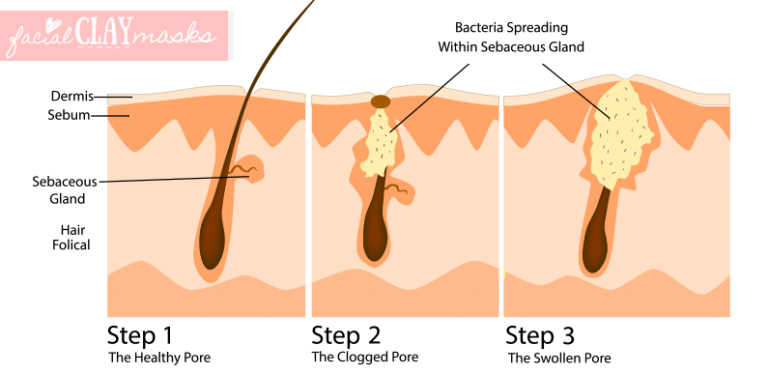 Acne 101: What are the Different Types of Acne?
