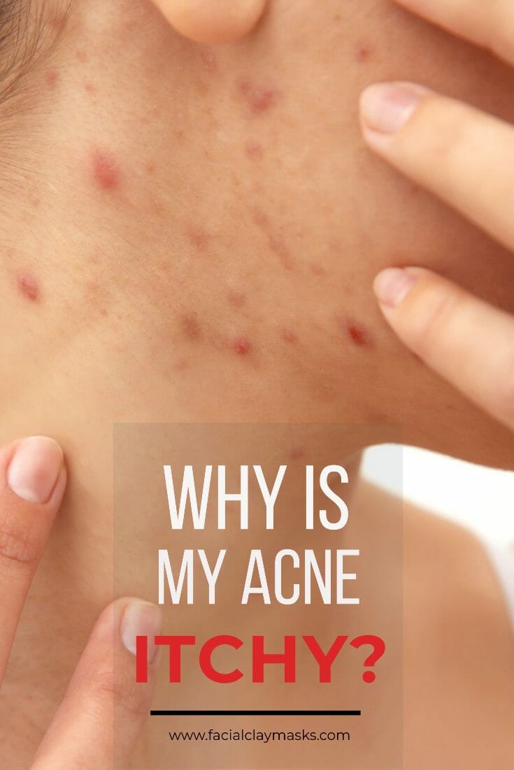 Can Acne Be Itchy Here s Why Can Acne Be Itchy Here s Why