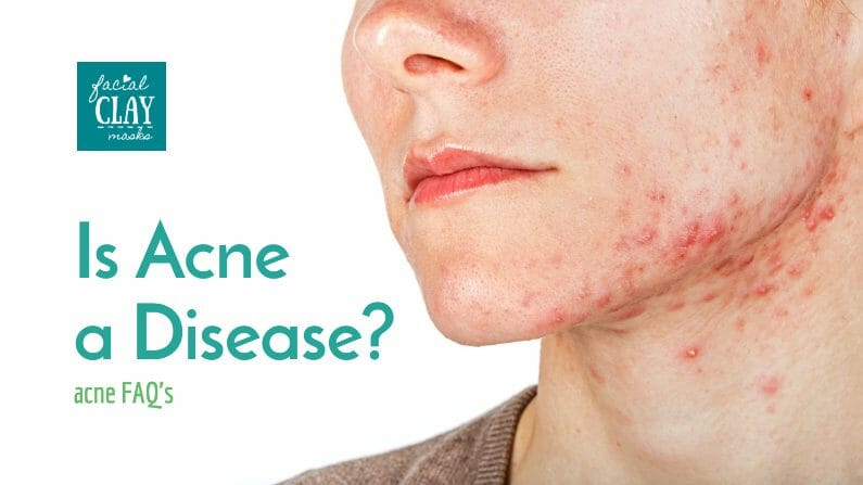 Is Acne a Disease? AKA Acne Vulgaris